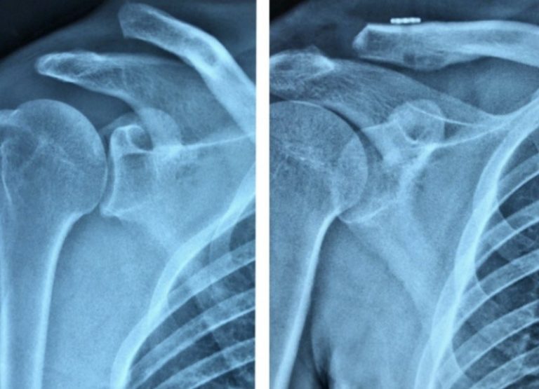 Acromioclavicular (AC) joint Surgery