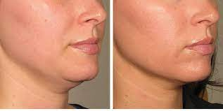 Get Rid Of Sagging Skin: 3 Quick Skin Tightening Treatment