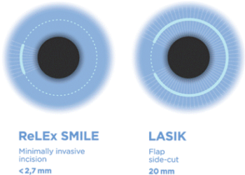 Is Lasik Surgery Right for You? What Factors Should You Think About First?