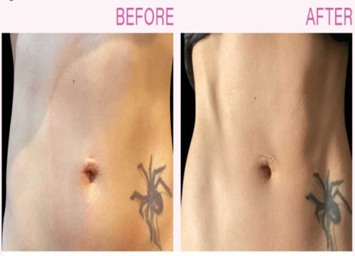 Emsculpt Neo: The Game Changer In Body Sculpting