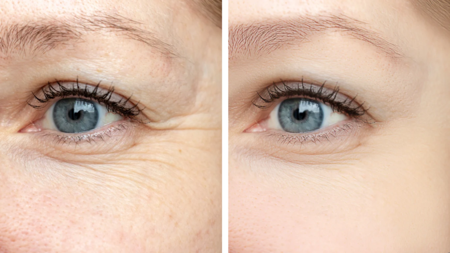 Wrinkles and Fine Lines: Causes, Prevention, And Treatments