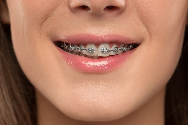 The Evolution of Fixed Braces: Modern Solutions for Orthodontics