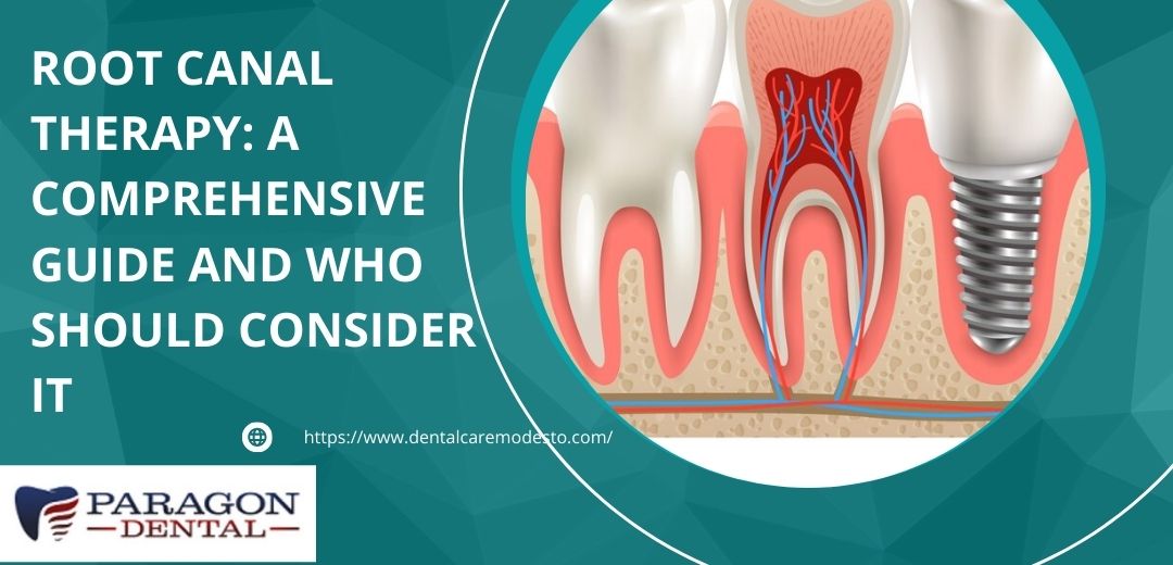 Root Canal Therapy: Comprehensive Guide