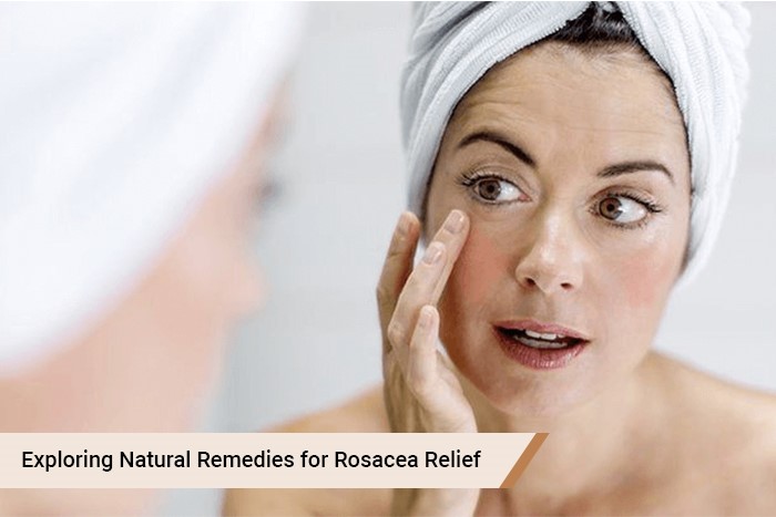 Natural Remedies for Rosacea Relief: A Comprehensive Guide