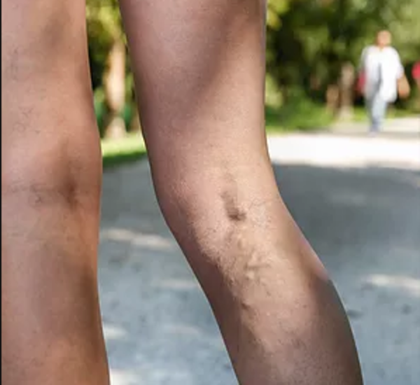 Vascular Conditions Recognising Symptoms and Risk Factors