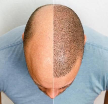 Scientifically Proven Hair Fall Treatments: Expert-Backed Solutions