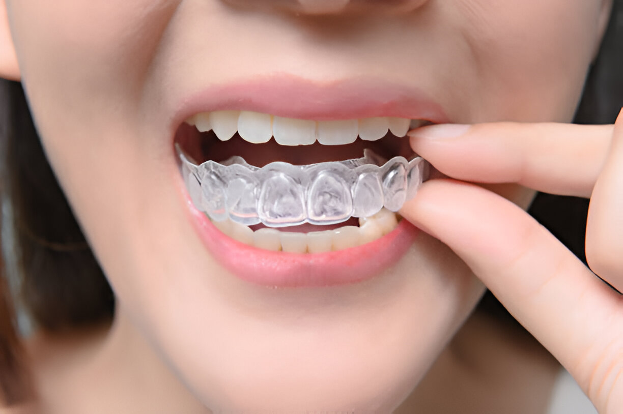 Can I Eat and Drink with My Invisalign® Aligners On?