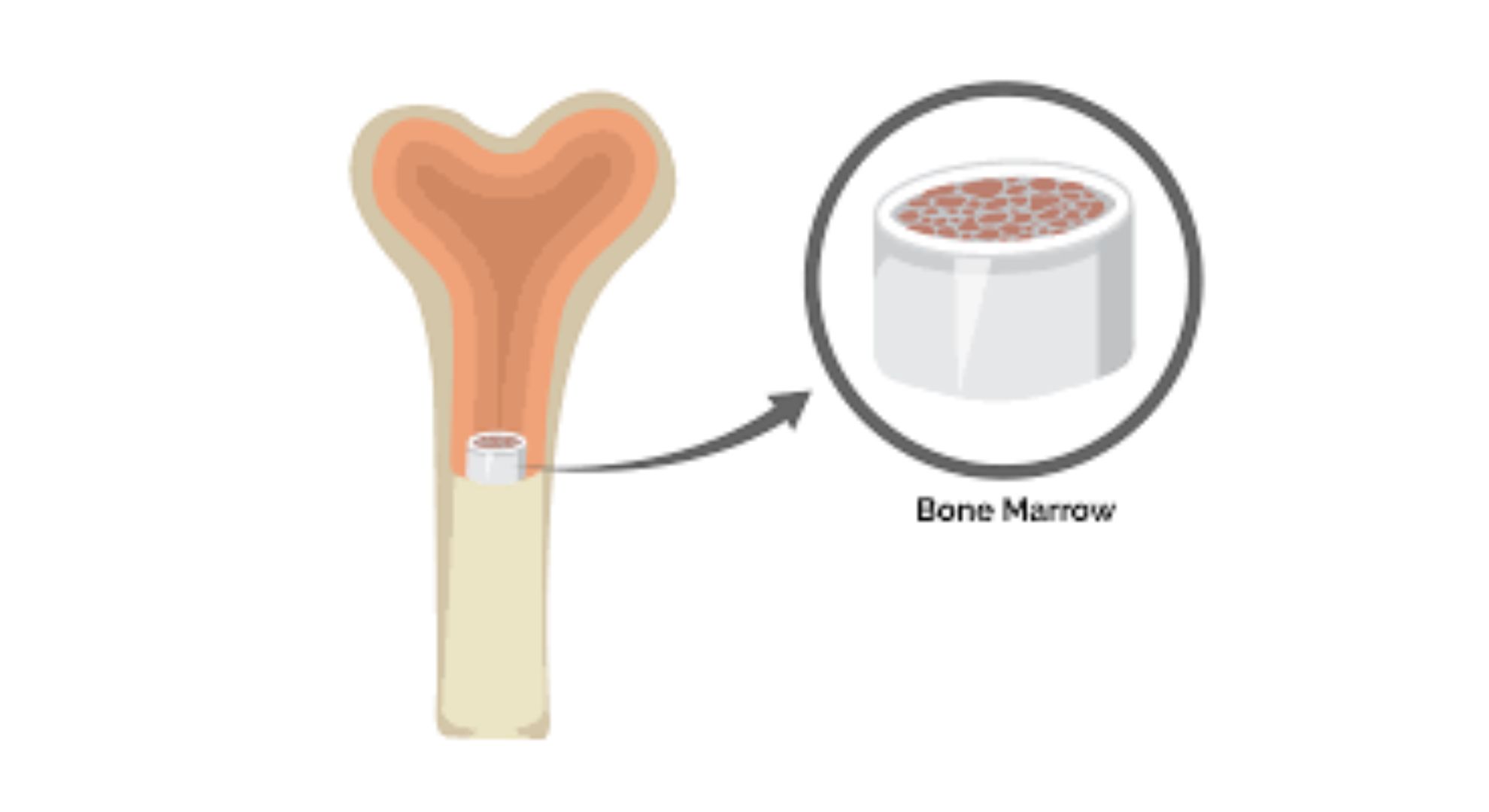 bone-marrow-transplant-life-saving-procedure