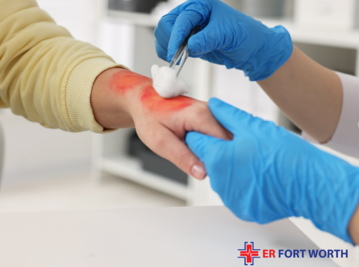 7 Life-Saving Burn Treatment Tips at Urgent Care 24 Hours
